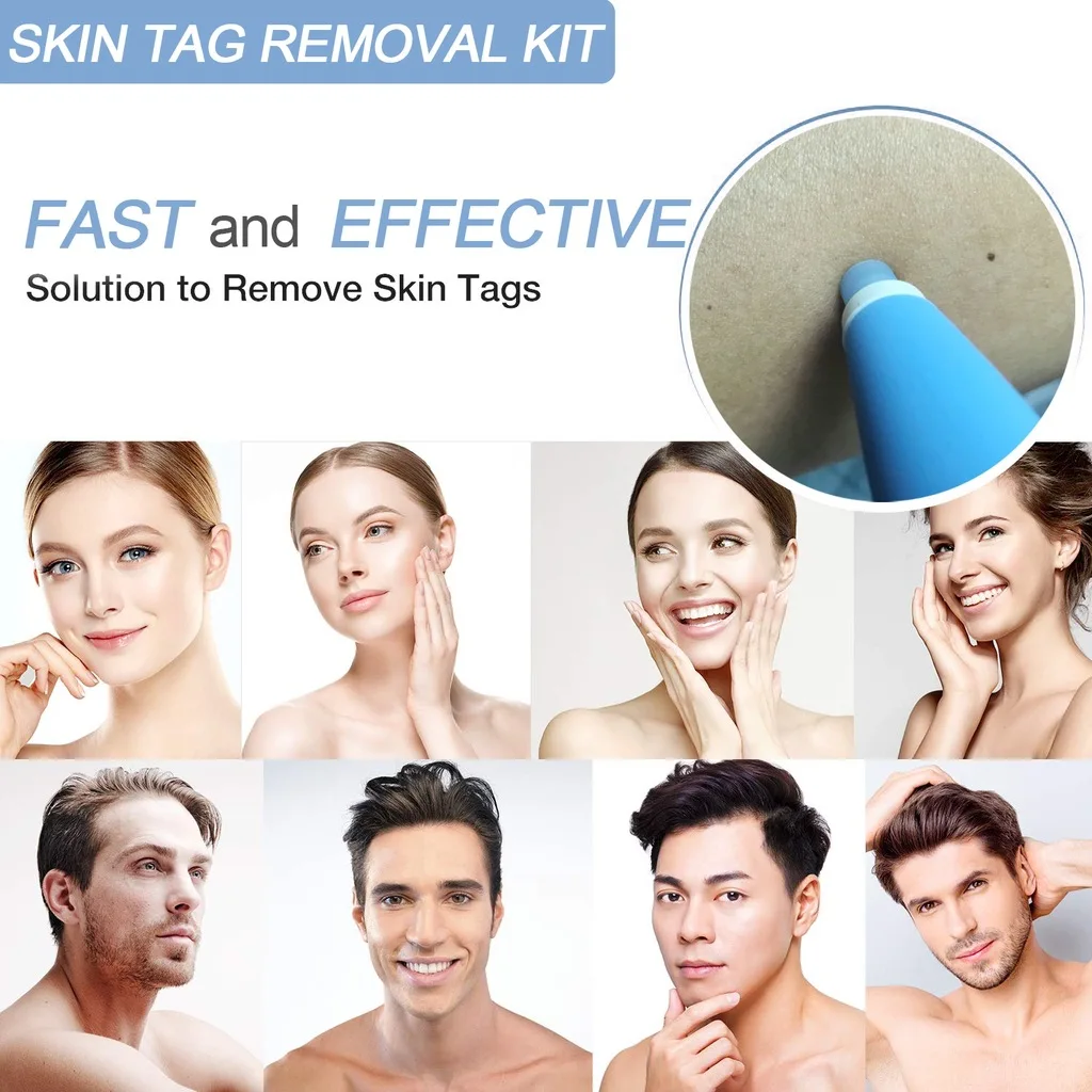 How To Remove Skin Tags On Face Naturally