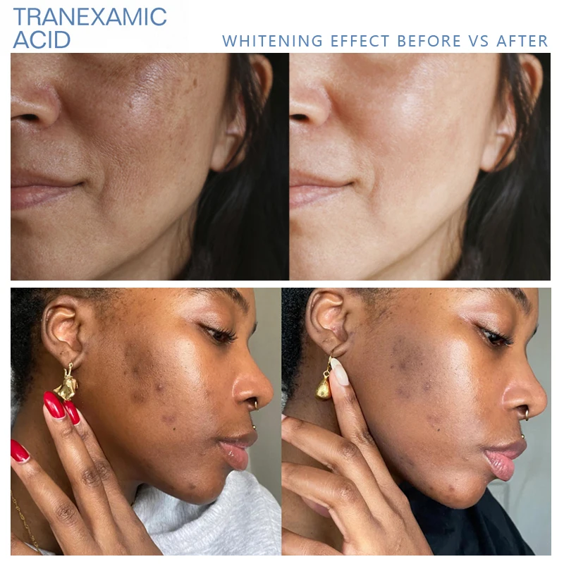 Skin Whitening Tranexamic Acid Factory Sale | www.ruthiesnotions.com