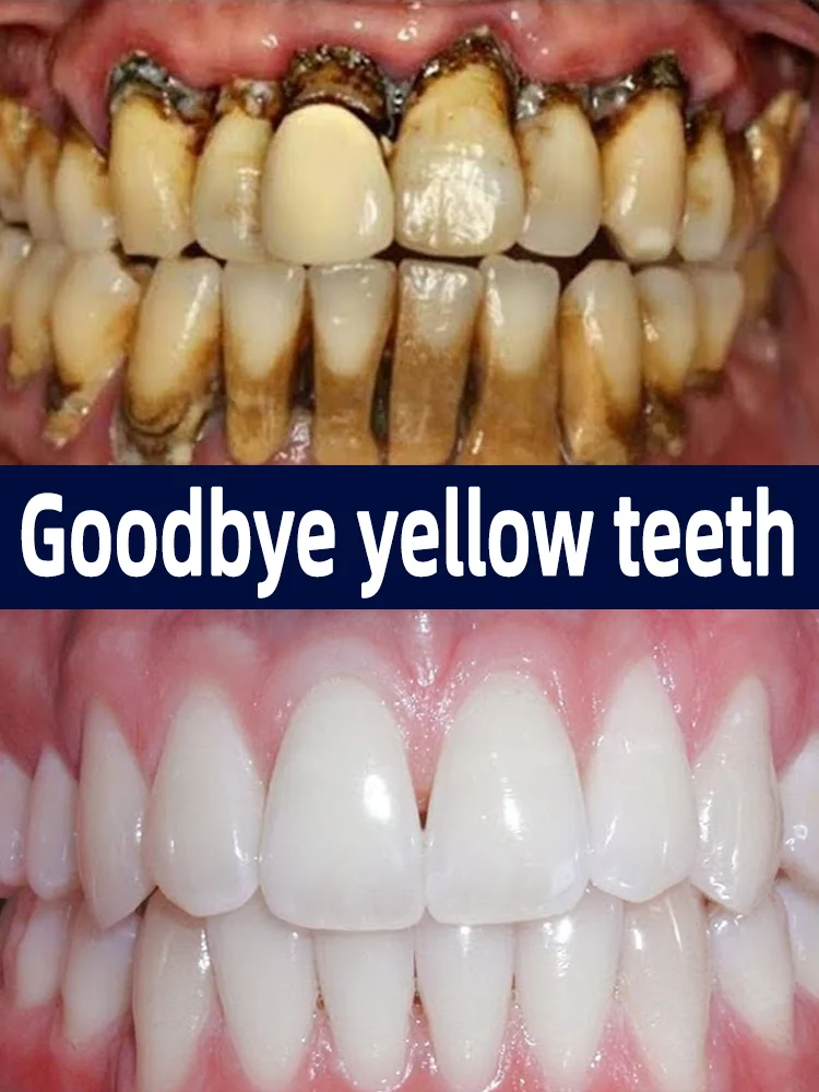 Yellow Teeth From Coffee