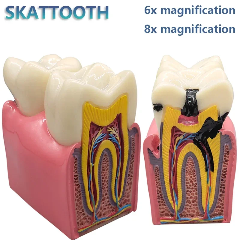8-Times-Dental-Caries-Model-Disease-Teeth-Dental-Model-for-Dental ...