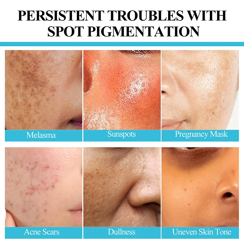 Hydroquinone Freckles Before And After