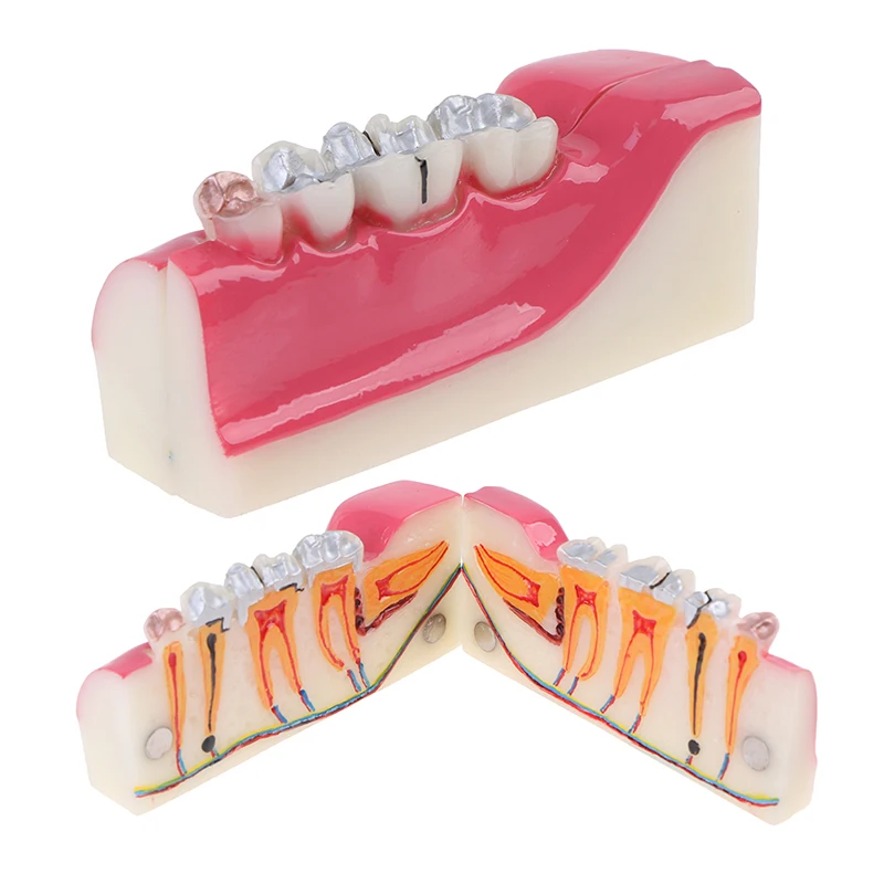 Teeth-Anatomy-Study-Model-Molar-Cross-Section-Decomposition-Model-Of ...