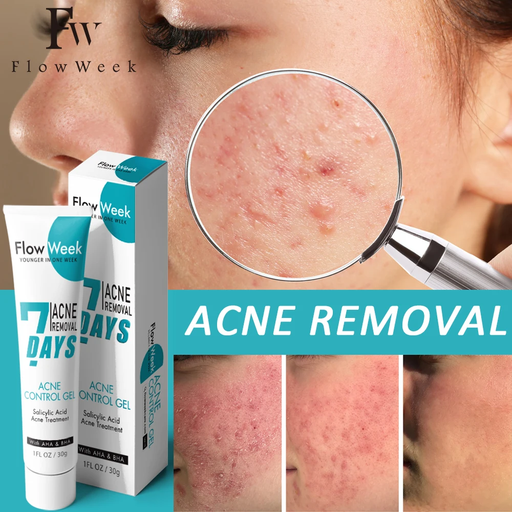 Flow-week-Salicylic-Acid-Acne-Treatment-Gel-Tea-Tree-Pimple-Spots ...