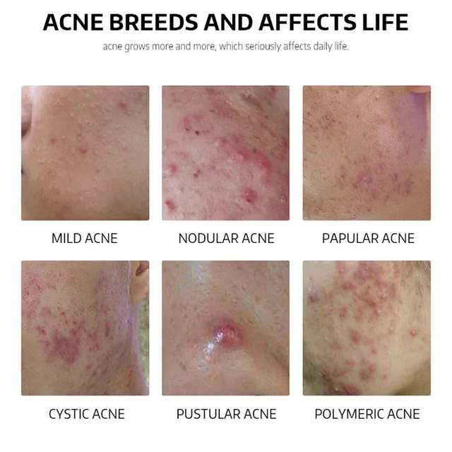 Mild Cystic Acne Treatment