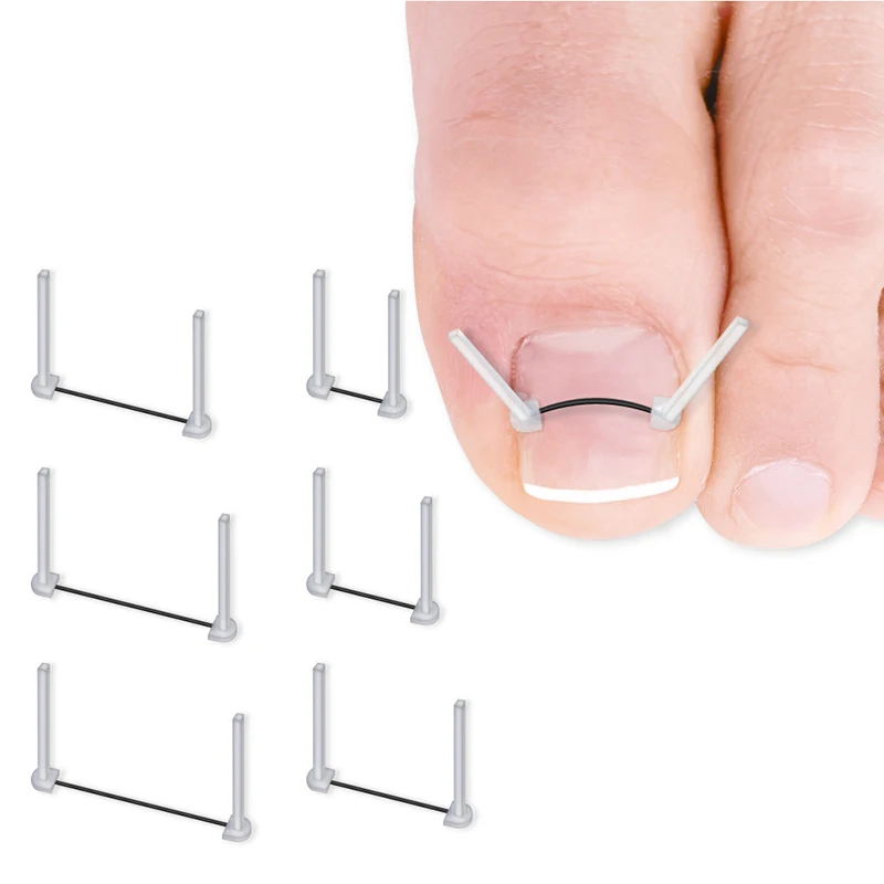 Nail-Care-Ingrown-Toenail-Correction-Wire-Fixer-Corrector-Pedicure-Nail.jpg
