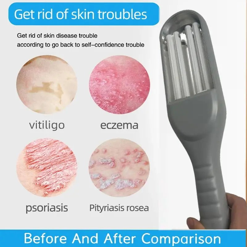 Home-311nm-UVB-Light-Therapy-Vitiligo-Psoriasis-Treatment-311nm ...
