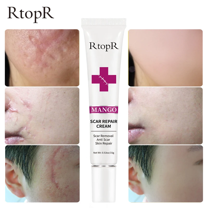 Rtopr Mango Acne Cream Anti Acne Cream Spots Scar Treatment, 58% OFF