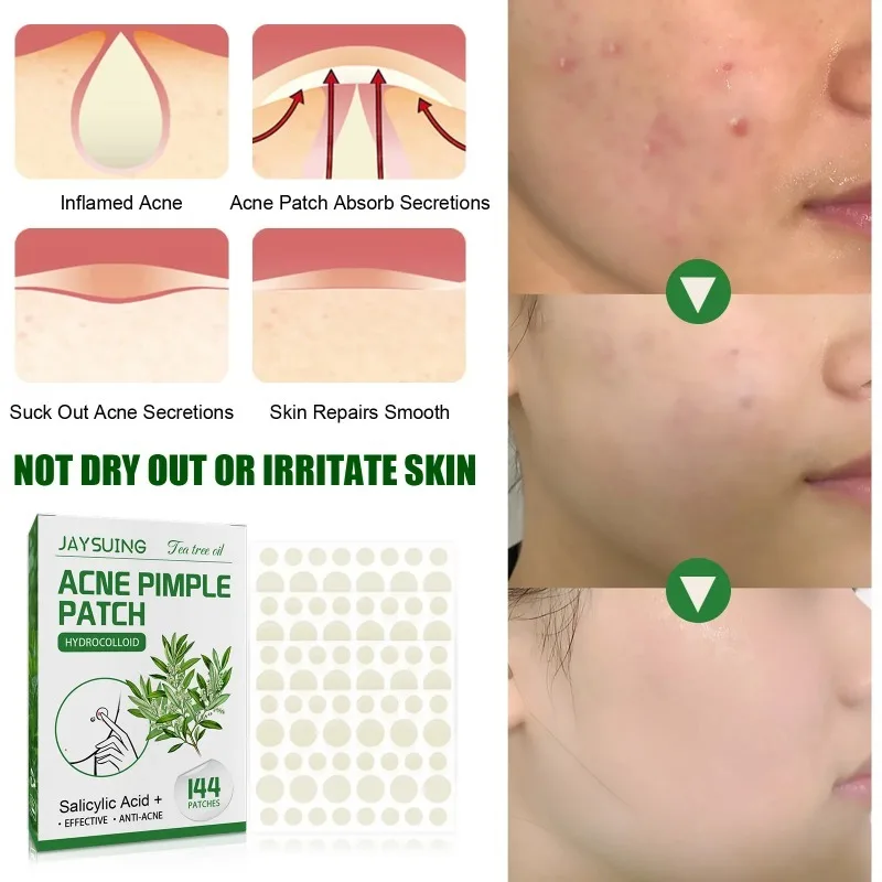 Pimple-Acne-Patch-para-Cuidados-Faciais-Adesivos-Invis-veis-Tratamento ...