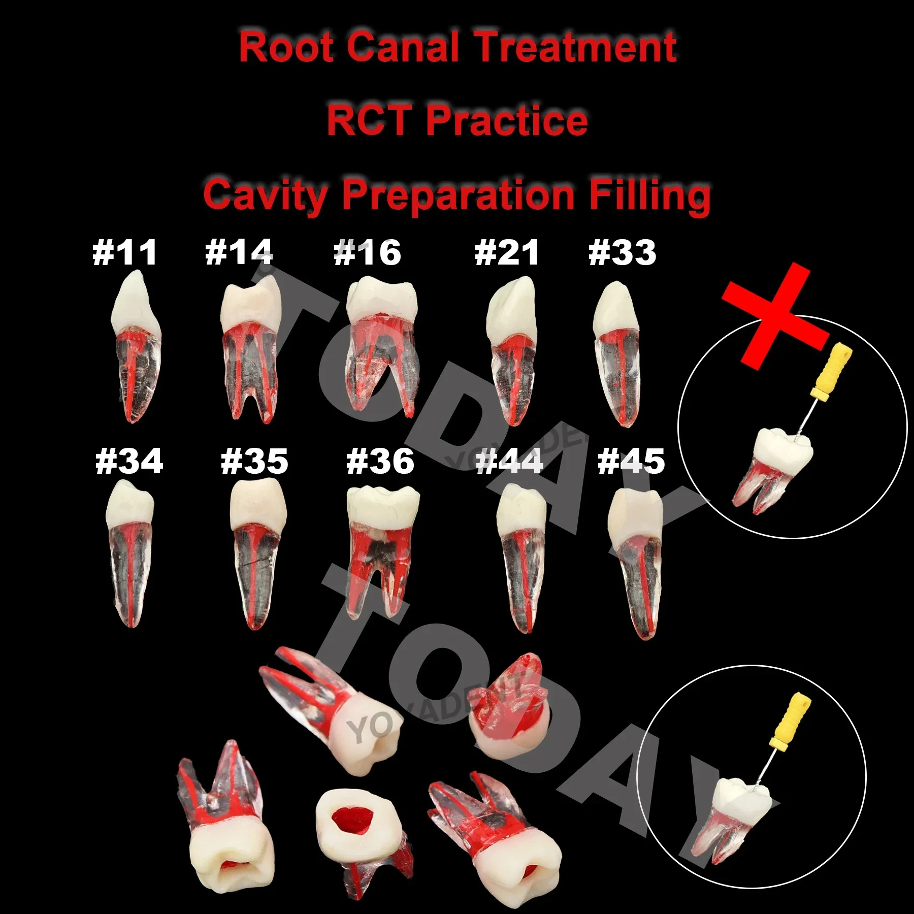 Estudo-de-tratamento-de-canal-radicular-endo-dental-modelo-de-pr-tica-rct-tipo-kilgore-nissin.jpg