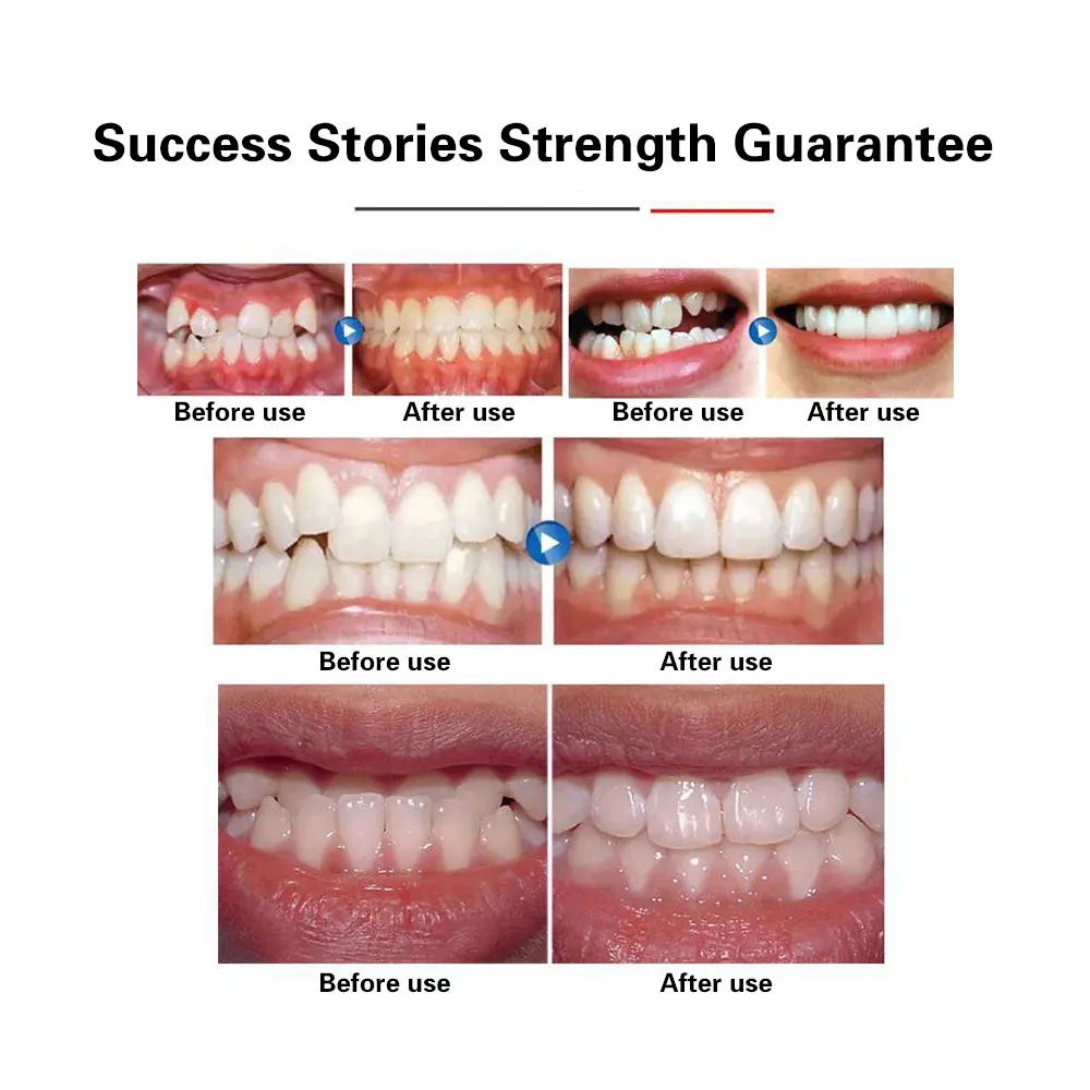 Retainer For Teeth Before And After