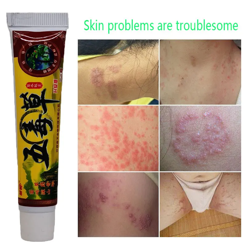 Psoriasis Eczema Cream Eczema Ointment Psoriasis Ointment Skin Dermatitis Cream Urticaria ...