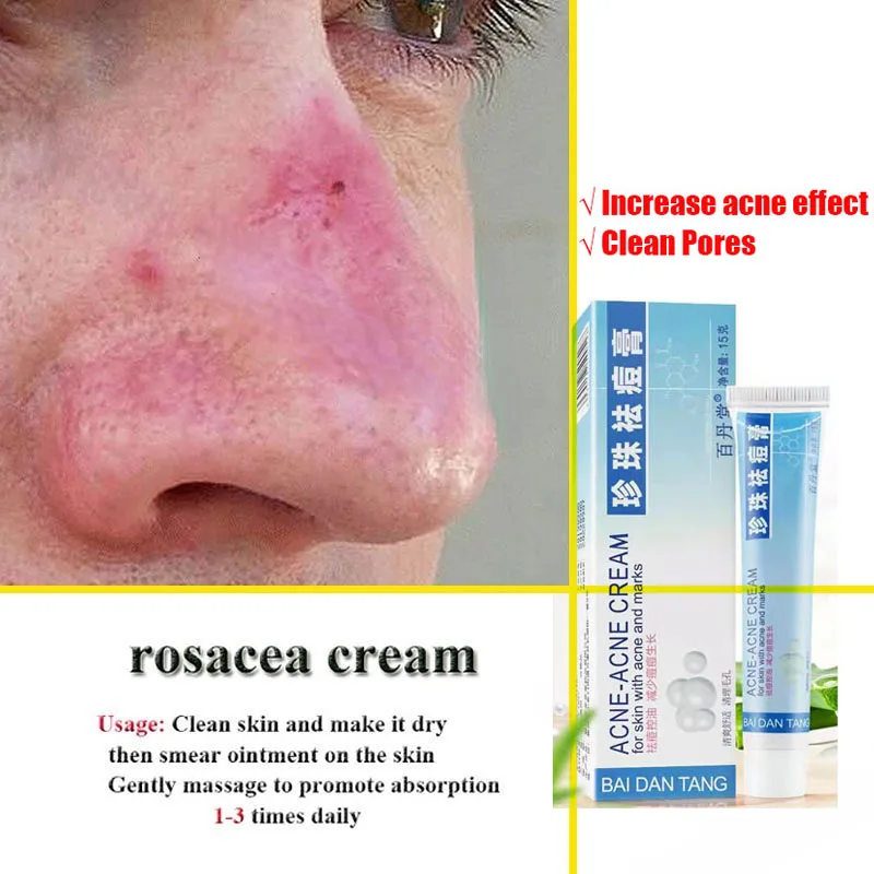 Cream For Rosacea Nose at Morgan Hamilton blog
