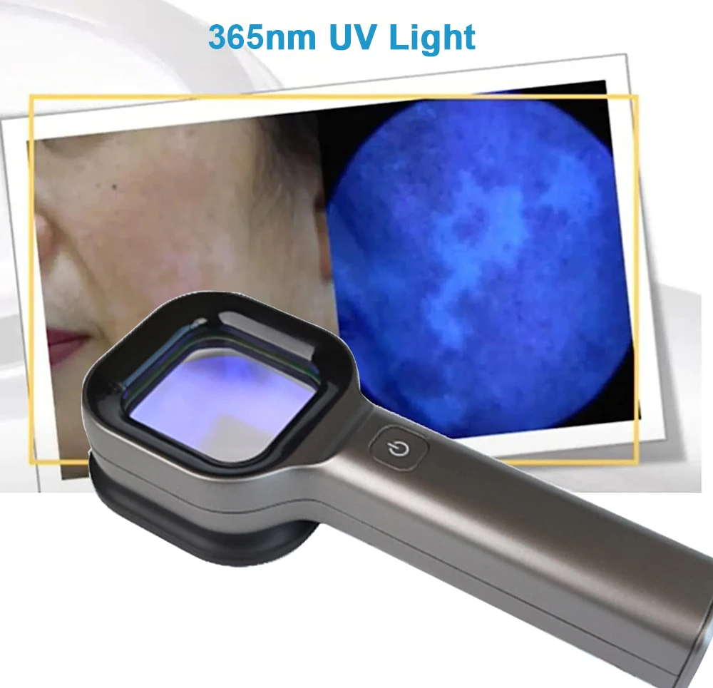 New Skin Analyzer With Woods Lamp Portable Vitiligo Detector Skin ...