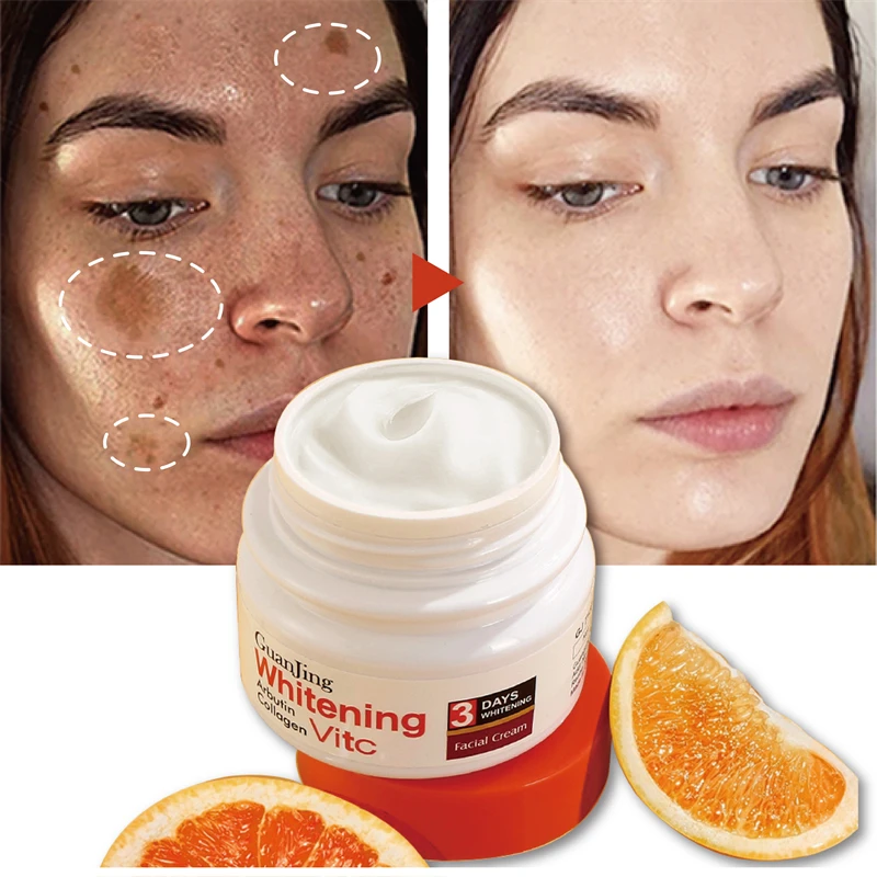 Whitening Freckle Cream Remove Melasma Dark Spot Lightening Melanin ...