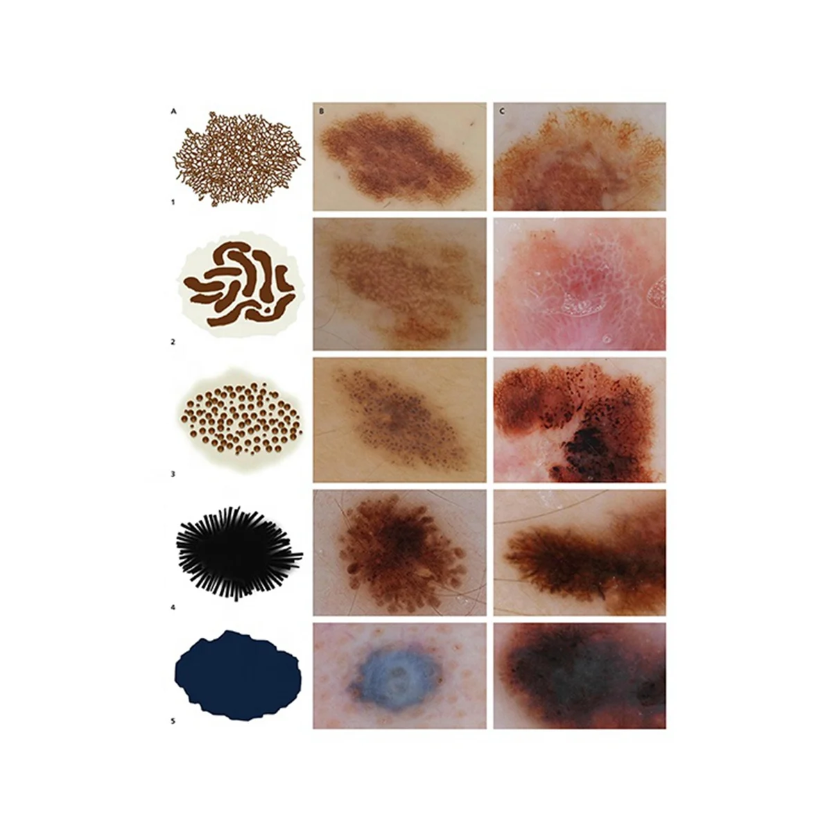 Dermatoscope-10X-Magnify-Macro-Zoom-Lens-for-Dermatology-Clinical-Mole ...