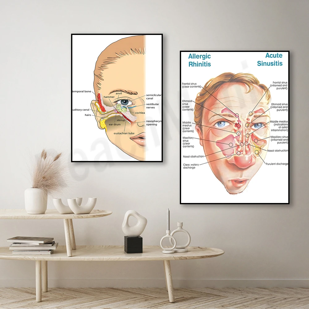 Allergic-rhinitis-and-acute-sinusitis-poster-human-anatomy-educational ...