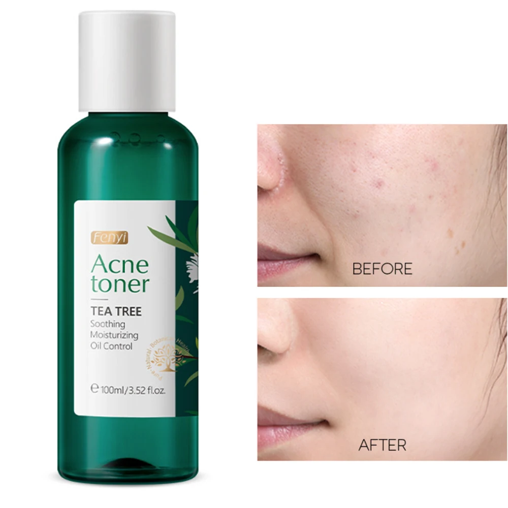 Tea Tree Oil Acne Before And After