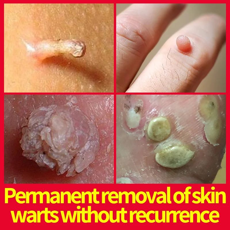 Cr-me-anti-verrues-plantaires-traitement-rapide-et-indolore-granul-s ...