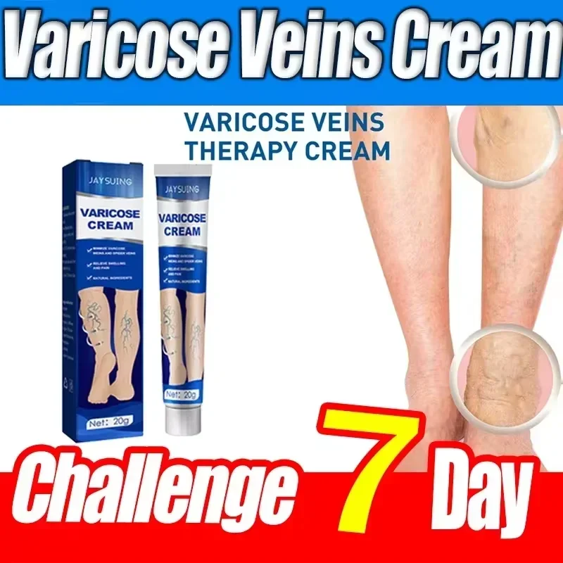 Ointment-for-Varicose-Veins-Eliminate-Vasculitis-Phlebitis-to-Relieve ...
