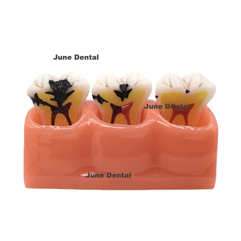 Dental Caries Progression
