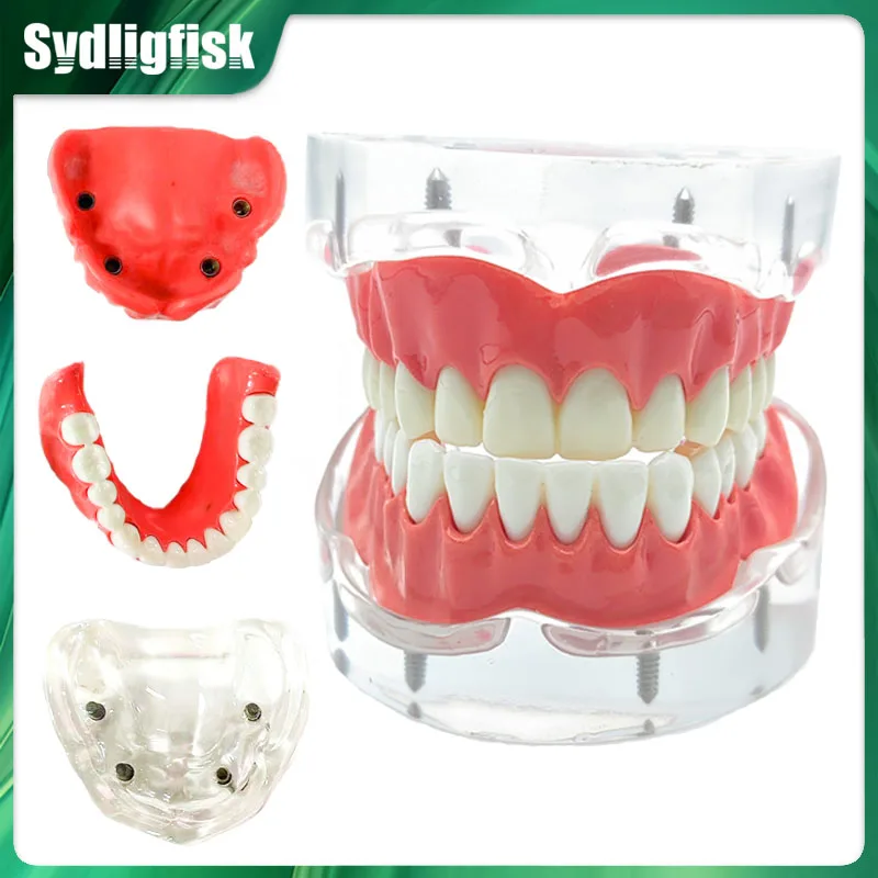 1/2Pcs Dental Implant Model Maxillary Mandibular Removable 4 Implant ...
