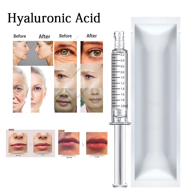 Hyaluronic Acid Lips