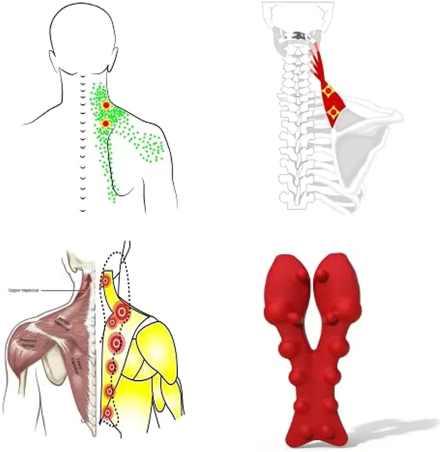 Suboccipital Trigger Points