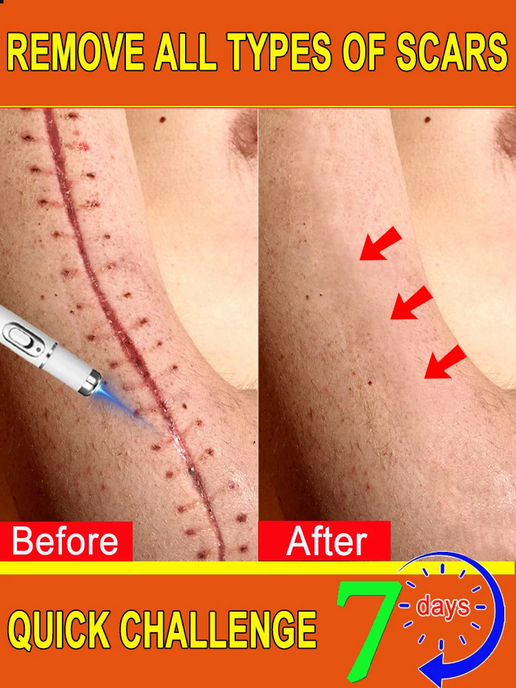 Laser-Scar-Hot-Selling.jpg