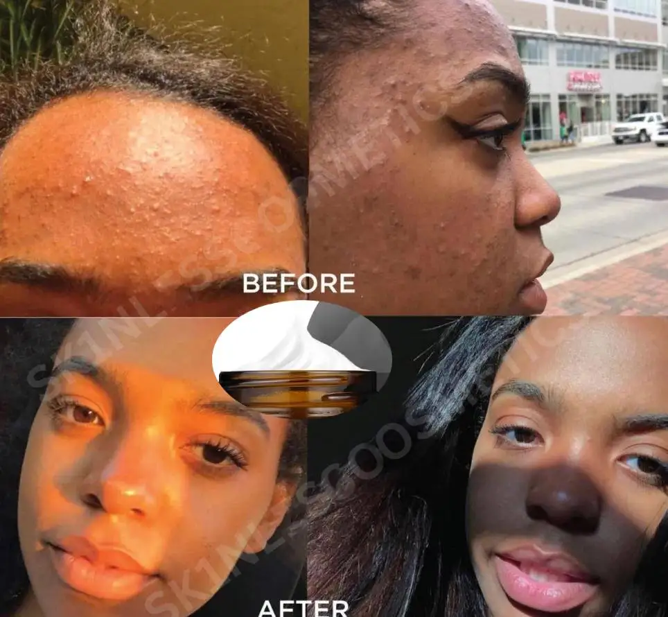 Skin Bleaching Products For Black Skin