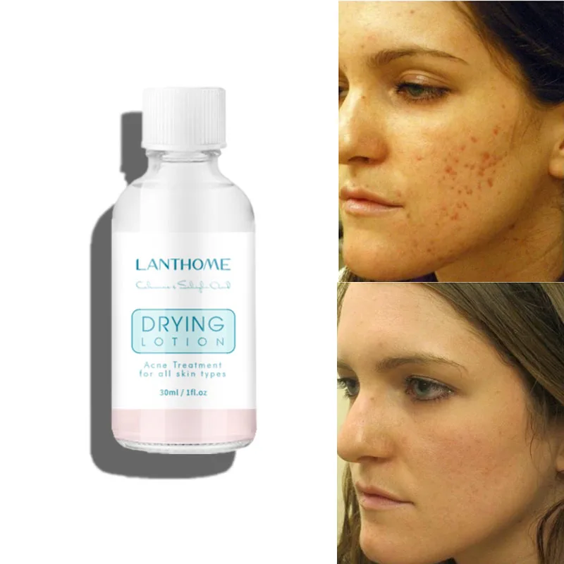 Calamine Lotion Acne