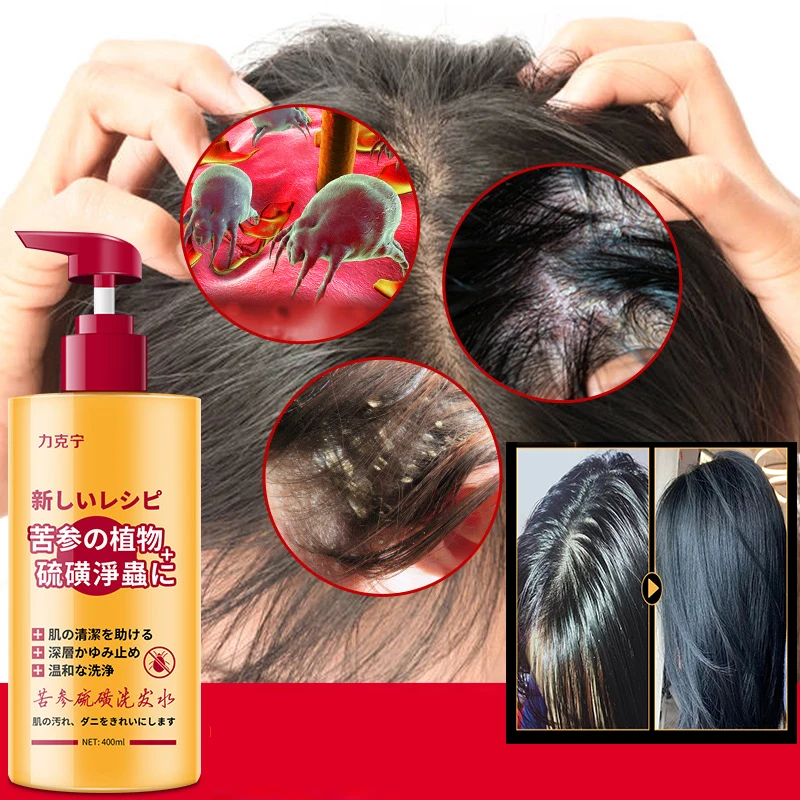 400ml Radix Sophorae Flavescentis Sulfur Shampoo for Removing Mites ...