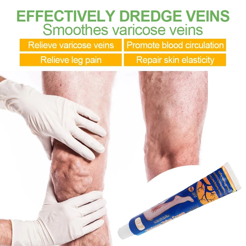 20g-Varicose-Veins-Ointment-Vasculitis-Phlebitis-Spider-Veins-Pain-Cure ...