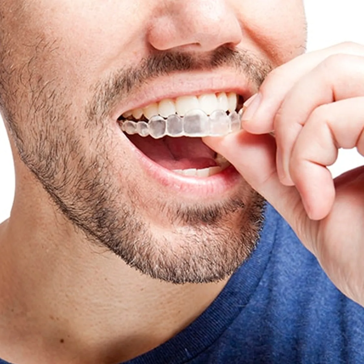 Invisalign-Thermoforming-Dental-Oral-Lab-Hygiene-Clenching-Grinding ...