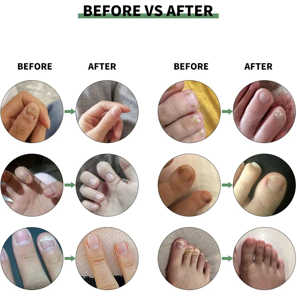 30ml Repair Nail Fungus Treatments Essence Foot Care Serum Toe Nails ...