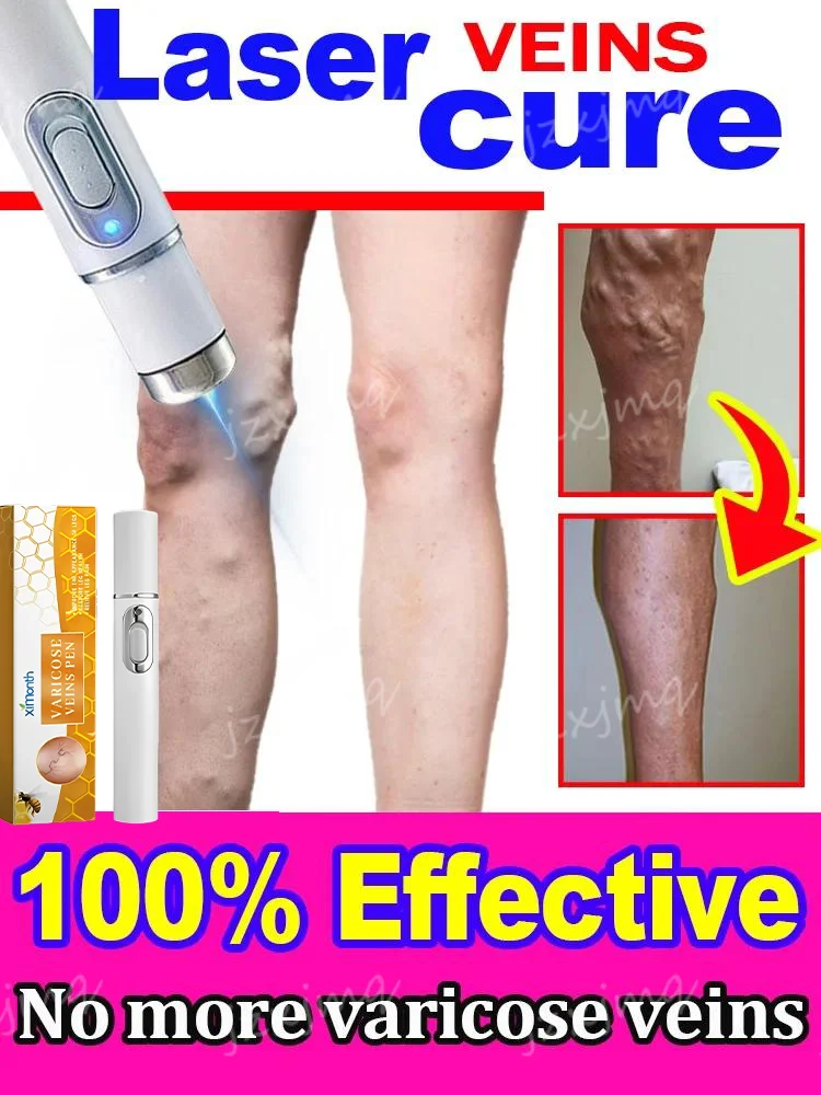 Varicose-Veins-Blue-Light-Pen-Laser.png