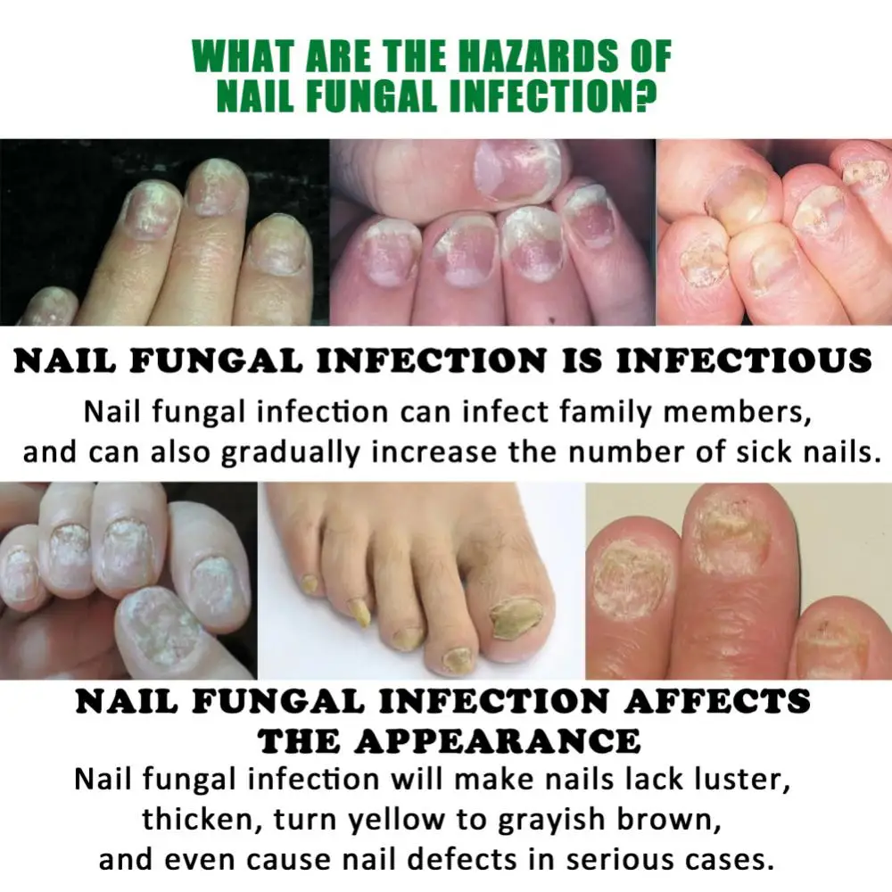 Hand Nail Fungus