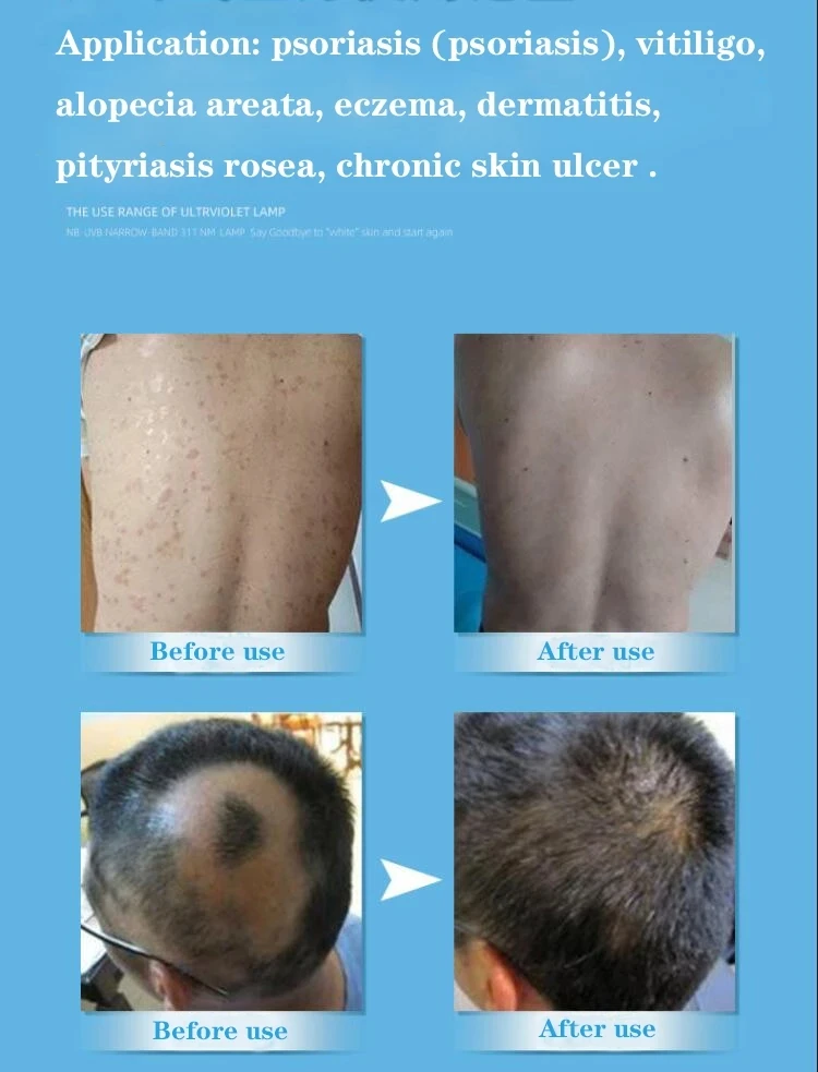 Pityriasis Rosea Before And After | ppgbbe.intranet.biologia.ufrj.br