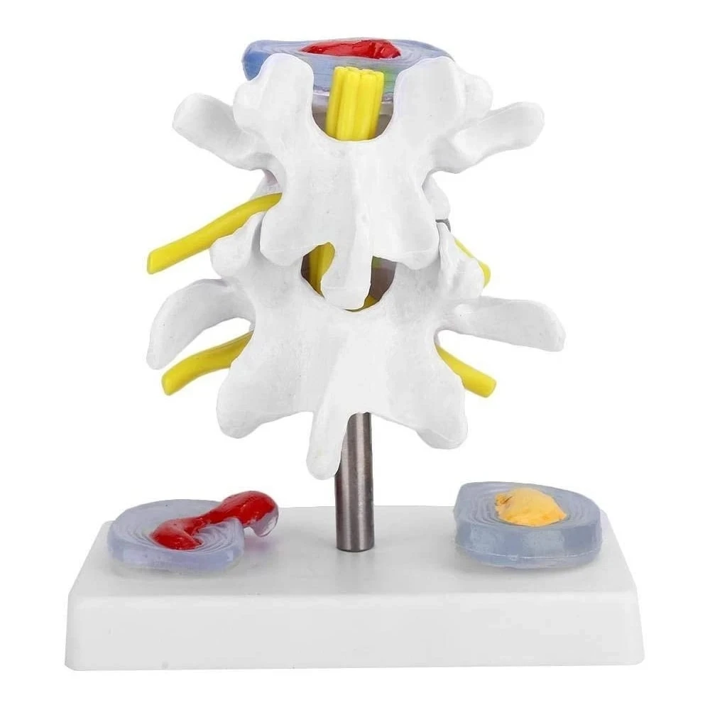 Intervertebral Disc Herniation Bone Pathology Model Lumbar Spine Bone ...