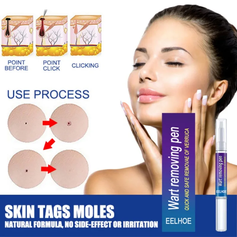 Mole Removal Cream