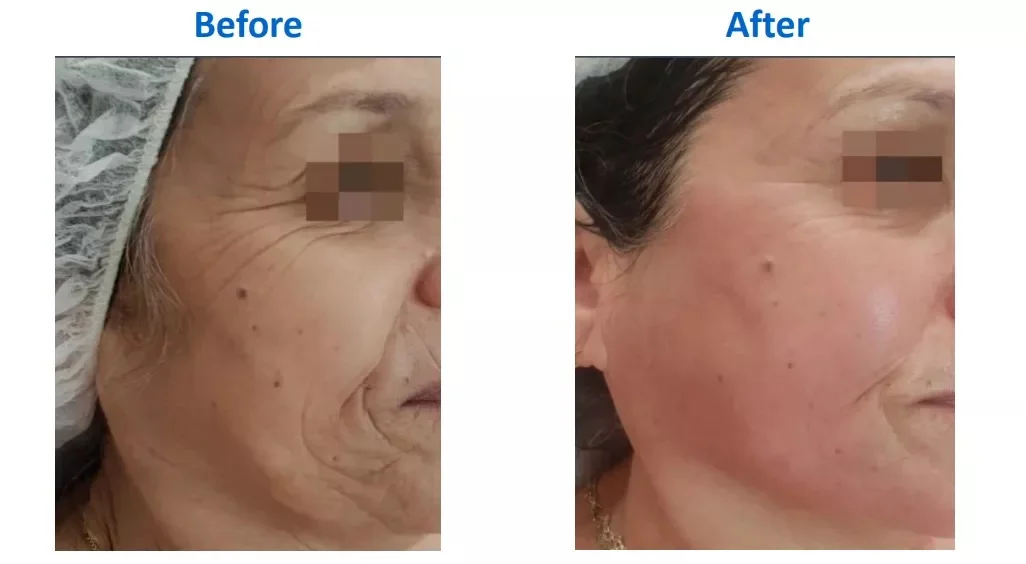 Apollo Duet Multipolar RF Technology With Electroporation For Skin ...