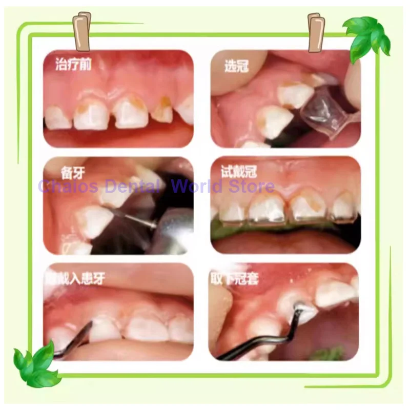 SHINHUNG-Clear-Primary-Resin-Anterior-Teeth-Crown-Forms-Dental-Kids ...