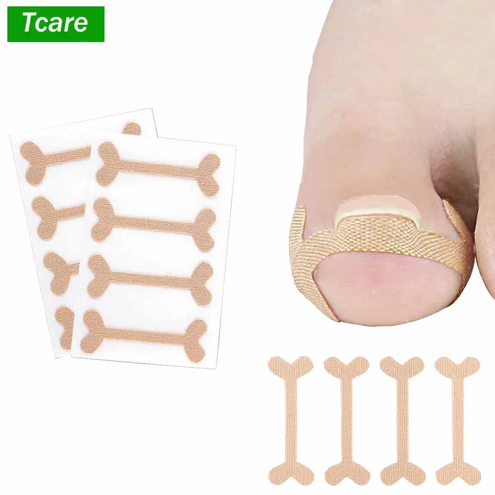 Tcare 1set Toe Nail Groove Foot Nail Orthodontic Device Thumb Nail ...