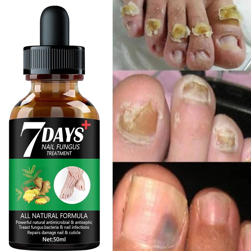 7days Nail Fungus Treatment Essence Serum Care Hand And Foot Care Removal Repair Gel Anti ...
