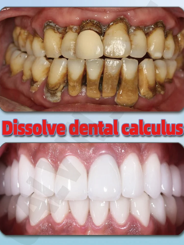 remover-dental-calculus-yellow-teeth-dental-plaque-Periodontitis ...