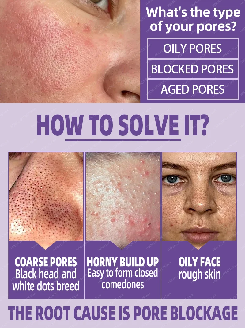 Large Pores On Face Treatment