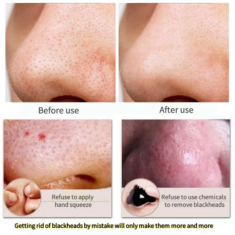 Nose Blackheads Before And After
