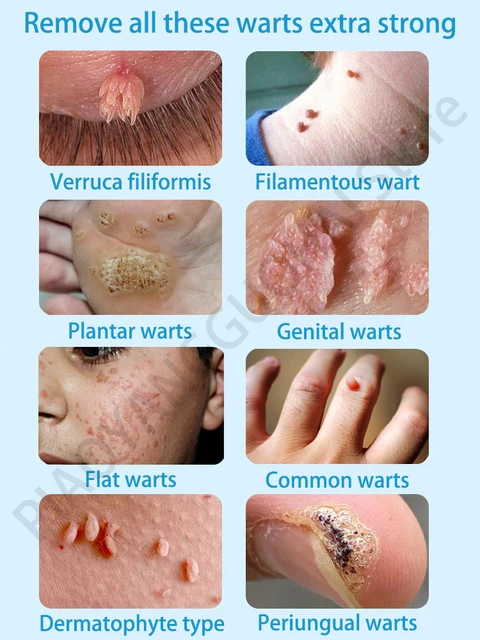 Filiform Warts