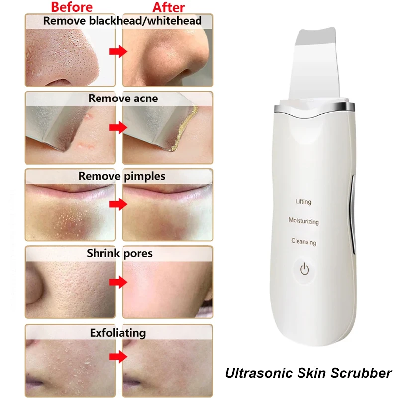 Ultrasonic-Skin-Scrubber-Vibration-Face-Spatula-Blackhead-Remover-Acne ...