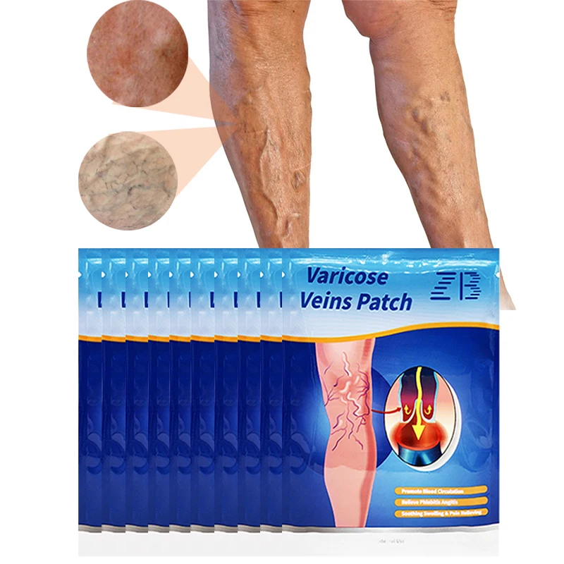 6/12pcs Varicose Veins Patch Vasculitis Phlebitis Spider Cream ...