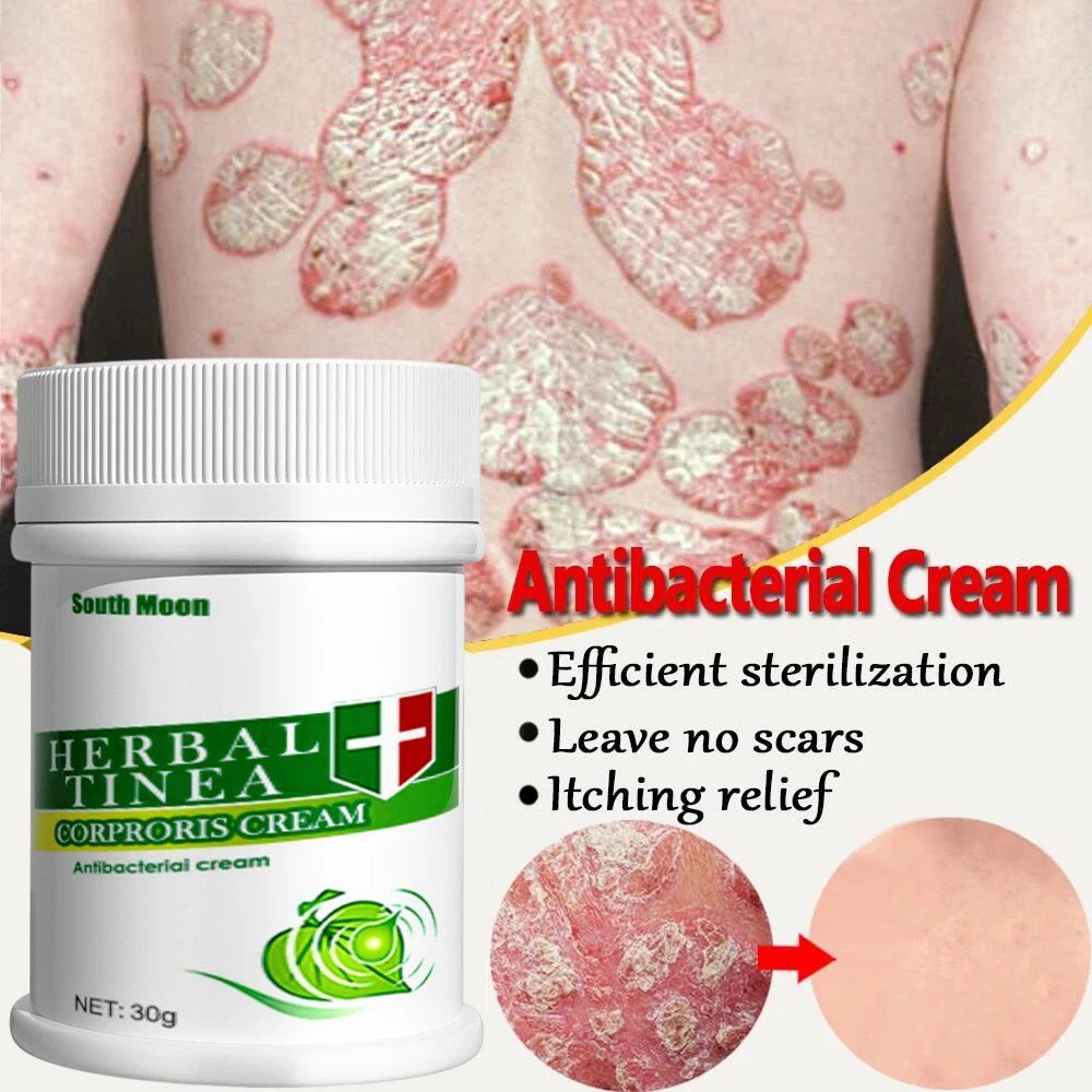Herbal-Psoriasis-Cream-Treatment-Dermatitis-Eczema-Antibacterial ...